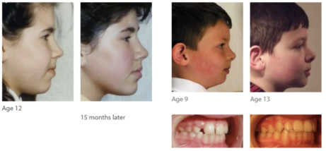 mewing postup a výsledky