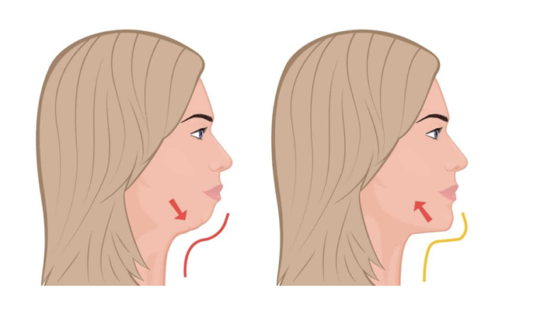 mewing postup a výsledky