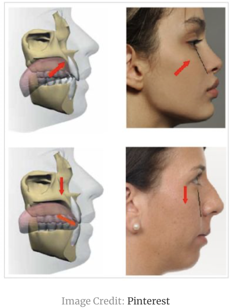mewing postup a výsledky