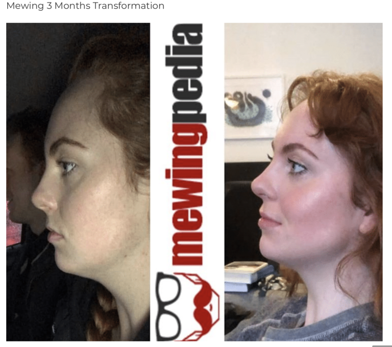 mewing postup a výsledky